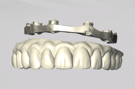 Prothèses Implantaires - DENTAL GALLERY