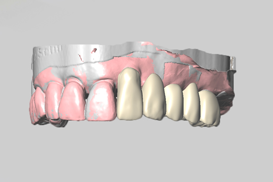 Prothèses Implantaires - DENTAL GALLERY